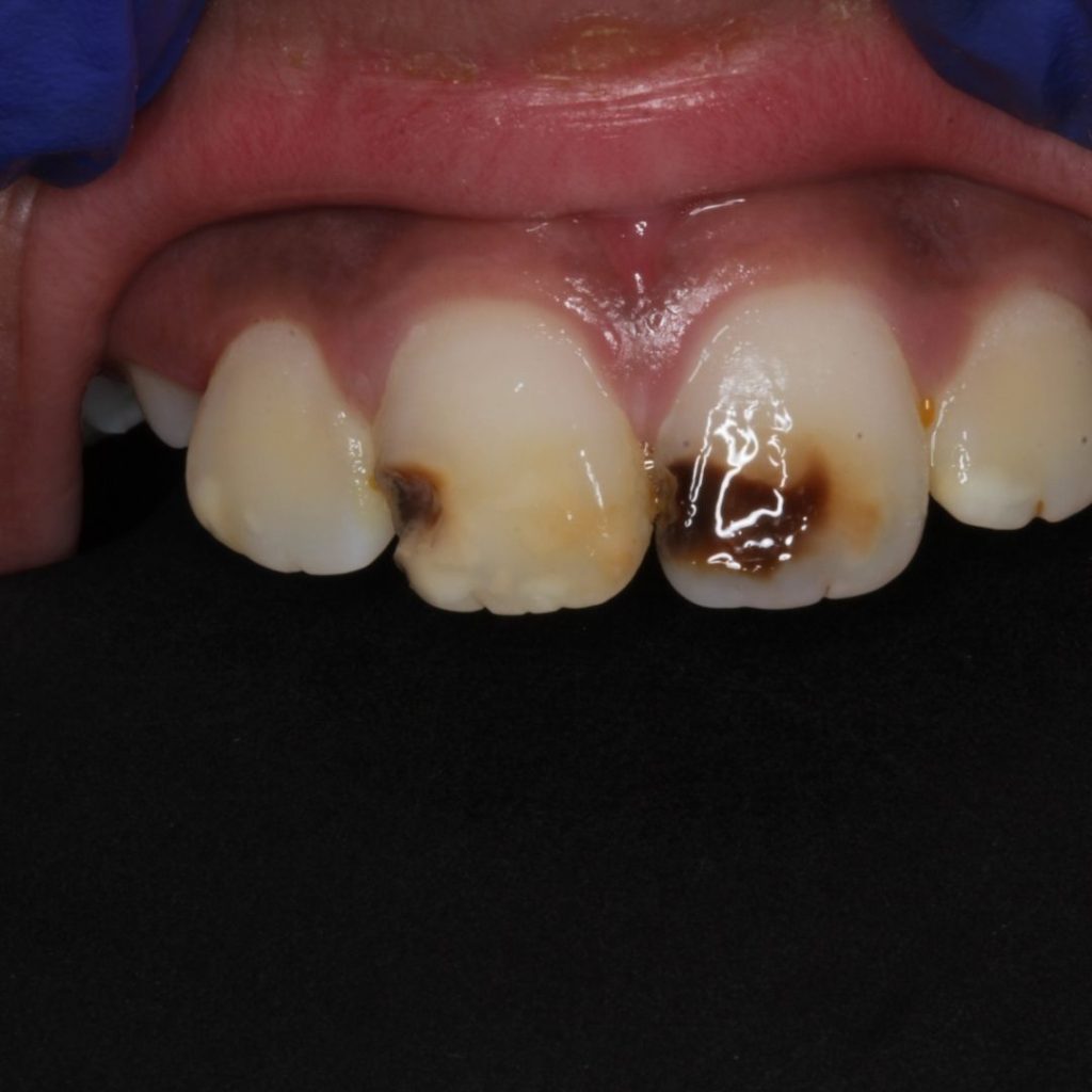 Molar Incisor Hypominerlization in Pune | Chalky Teeth | Vanilla Smiles