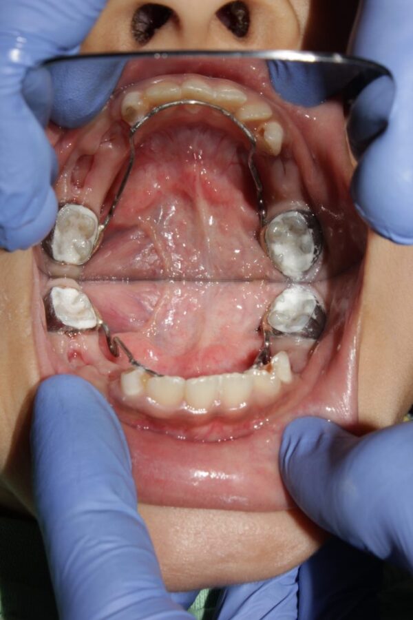 Space Maintainers in Shivaji Nagar Pune | Vanilla smiles