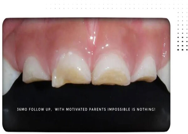 Minimally Invasive Pediatric Dentistry | Halls Technique in Pune