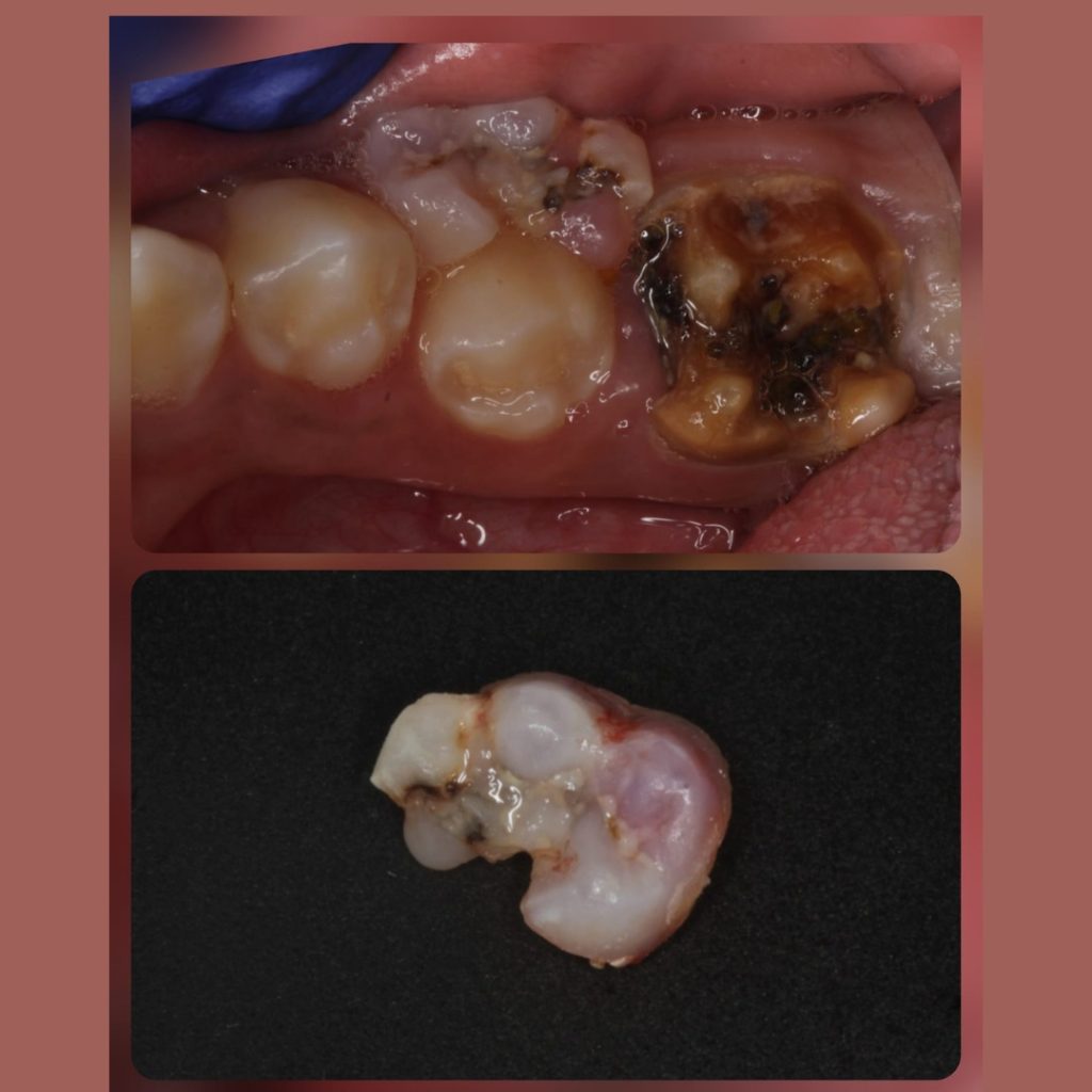 Molar Incisor Hypominerlization in Pune | Chalky Teeth | Vanilla Smiles