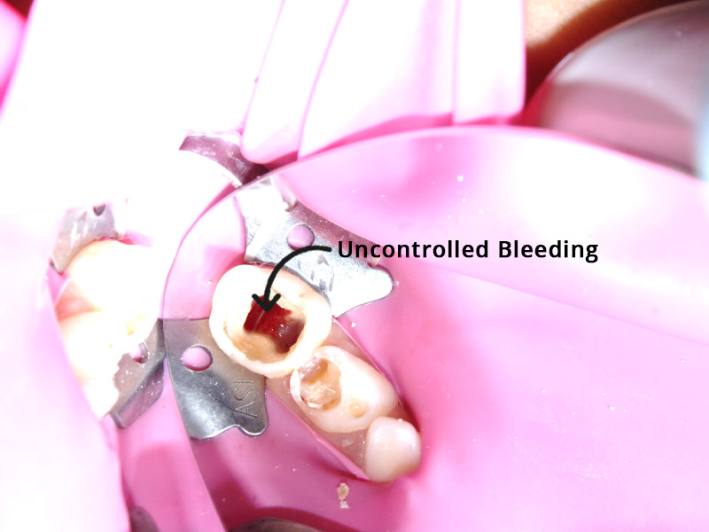 Painless Root Canal Treatment for Children in Pune | Vanilla Smiles