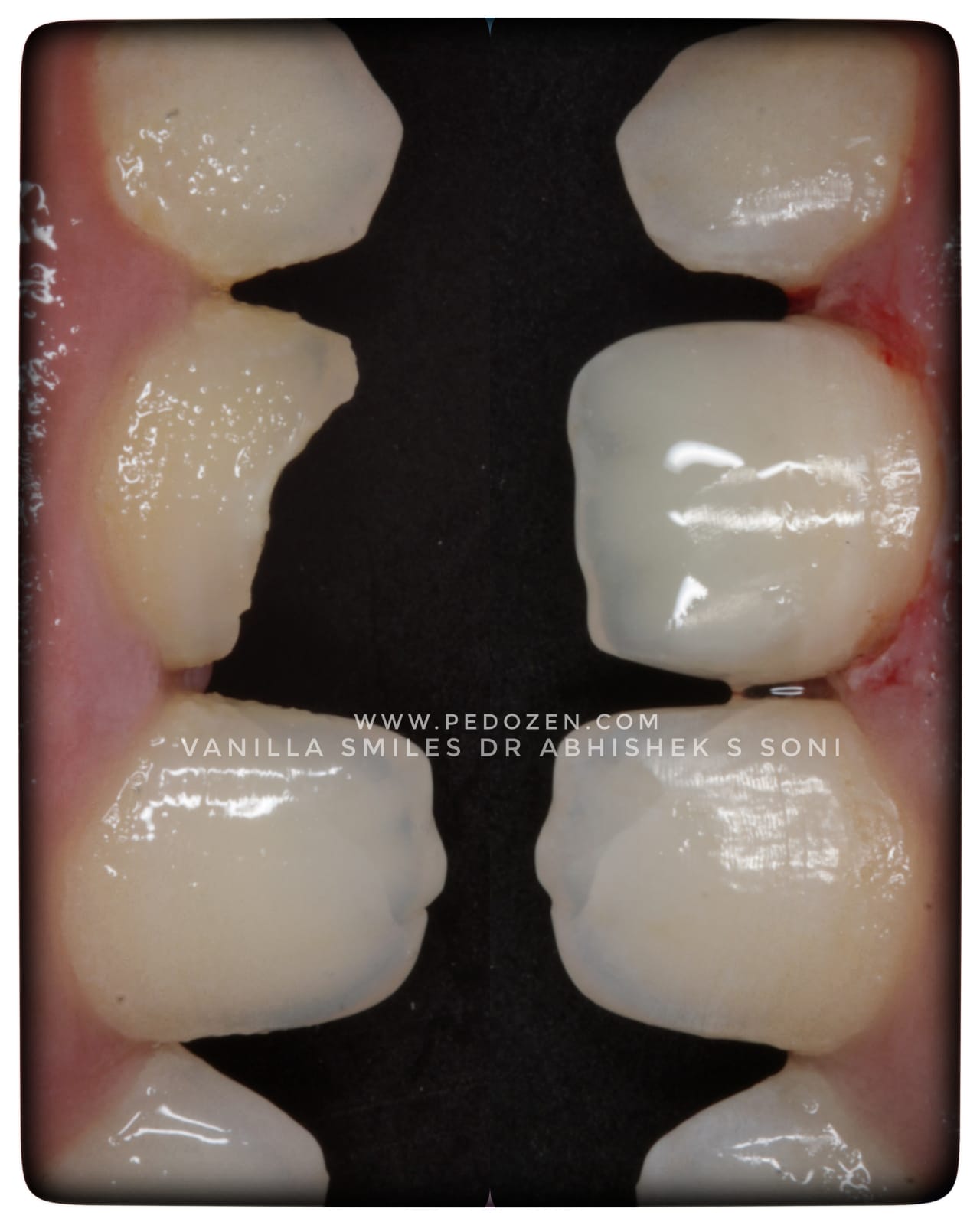 Dental Trauma in Kids | Avulsed Injury Prevention in Pune