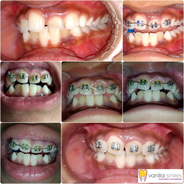 Anterior Cross Bite - Overview, Effect & Treatment