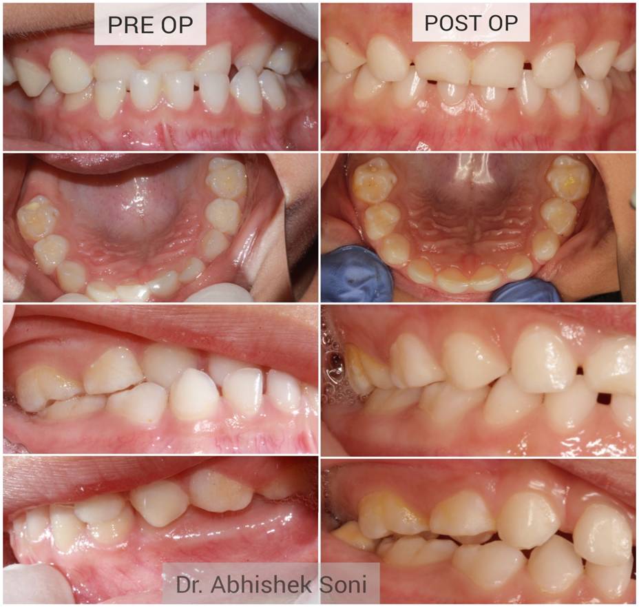 Anterior Cross Bite - Overview, Effect & Treatment