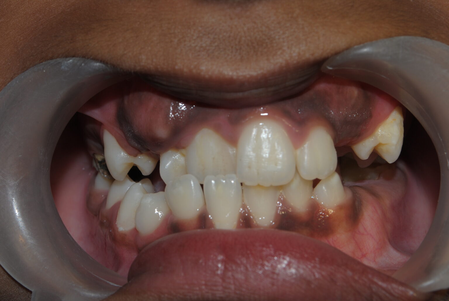 Anterior Cross Bite - Overview, Effect & Treatment