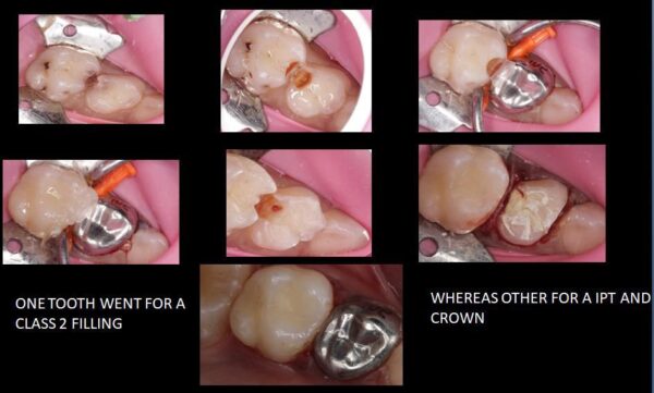 Class 2 Caries And Their Restoration - Vanilla Smiles Dental Clinic