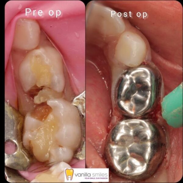 Class 2 Caries And Their Restoration - Vanilla Smiles Dental Clinic