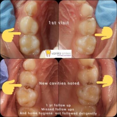 Class 2 Caries And Their Restoration - Vanilla Smiles Dental Clinic