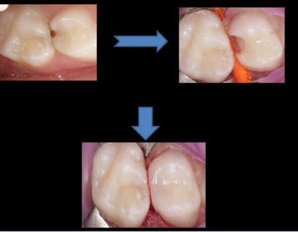 Class 2 Caries And Their Restoration - Vanilla Smiles Dental Clinic