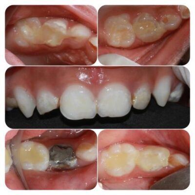 Class 2 Caries And Their Restoration - Vanilla Smiles Dental Clinic