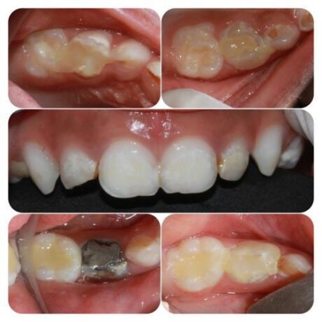 Class 2 Caries And Their Restoration - Vanilla Smiles Dental Clinic
