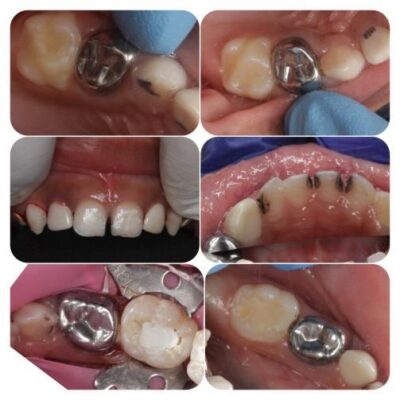 Class 2 Caries And Their Restoration - Vanilla Smiles Dental Clinic