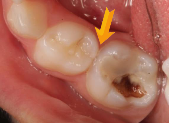 Class 2 Caries And Their Restoration - Vanilla Smiles Dental Clinic