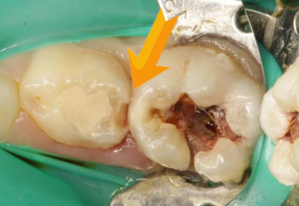 Class 2 Caries And Their Restoration - Vanilla Smiles Dental Clinic