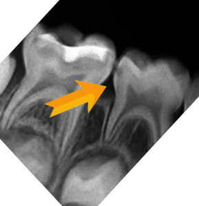 Class 2 Caries And Their Restoration - Vanilla Smile Dental Clinic