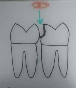 Class 2 Caries And Their Restoration - Vanilla Smiles Dental Clinic