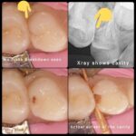 Class 2 Caries And Their Restoration - Vanilla Smiles Dental Clinic