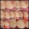 Class 2 Caries And Their Restoration - Vanilla Smiles Dental Clinic