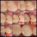 Class 2 Caries And Their Restoration - Vanilla Smiles Dental Clinic