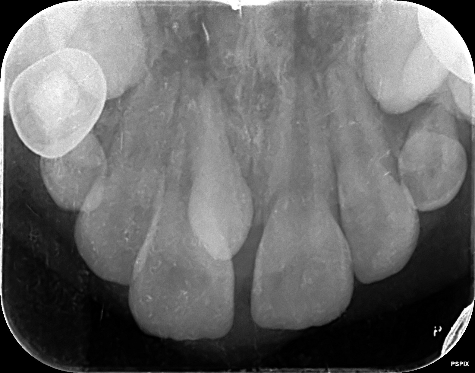 What Is a Mesiodense (Extra Tooth)? - Causes, Diagnosis & Treatment