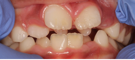What Is a Mesiodense (Extra Tooth)? - Causes, Diagnosis & Treatment