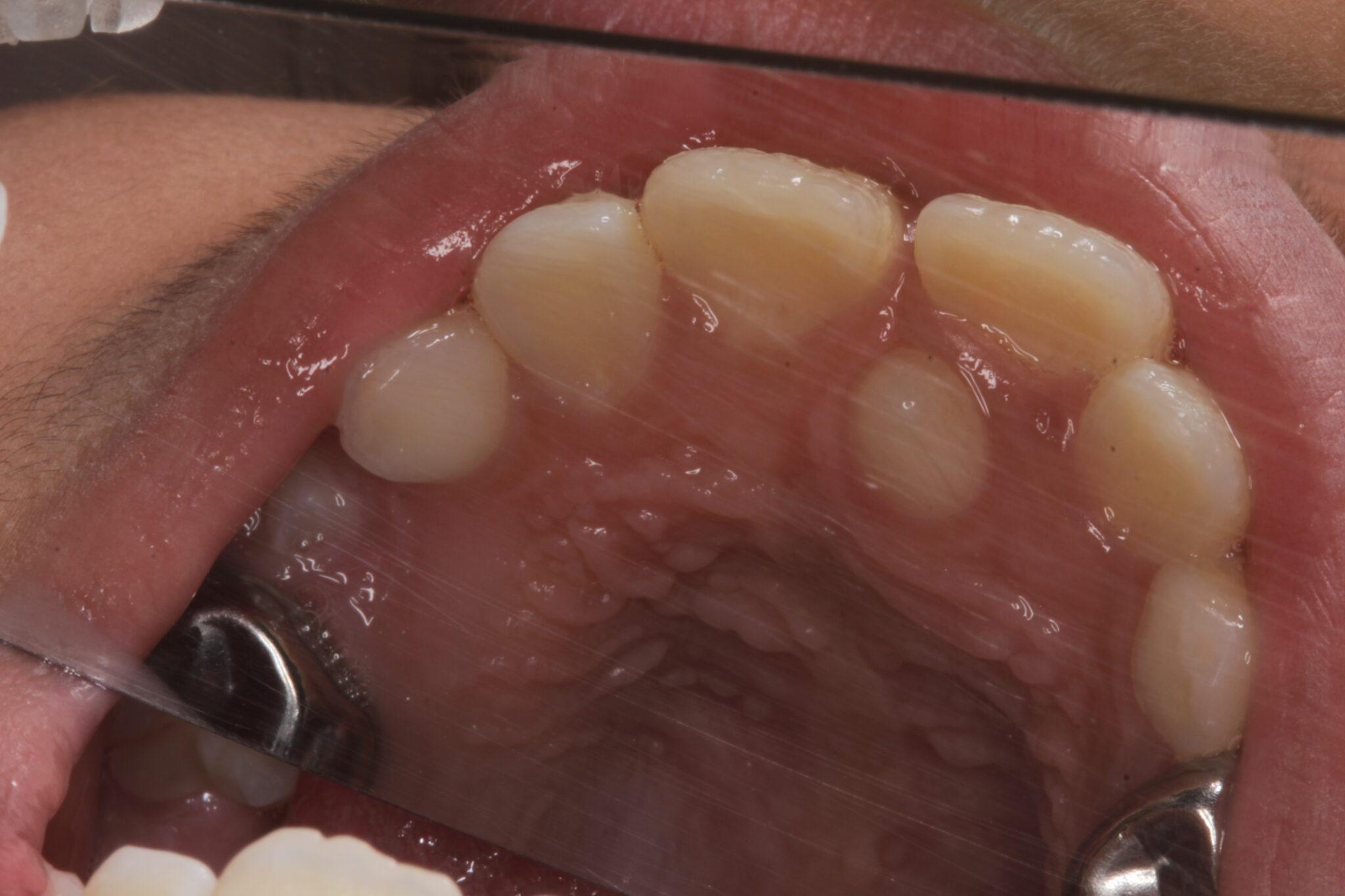 What Is a Mesiodense (Extra Tooth)? - Causes, Diagnosis & Treatment