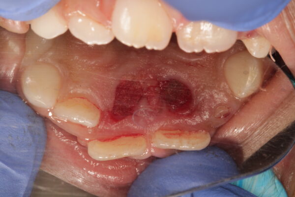 What Is a Mesiodense (Extra Tooth)? - Causes, Diagnosis & Treatment