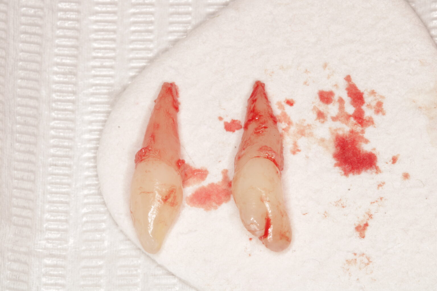 What Is a Mesiodense (Extra Tooth)? - Causes, Diagnosis & Treatment