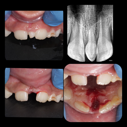 What Is a Mesiodense (Extra Tooth)? - Causes, Diagnosis & Treatment