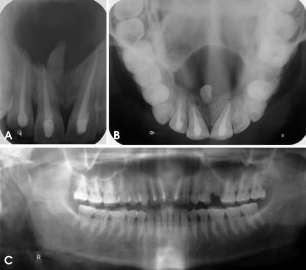 What Is a Mesiodense (Extra Tooth)? - Causes, Diagnosis & Treatment