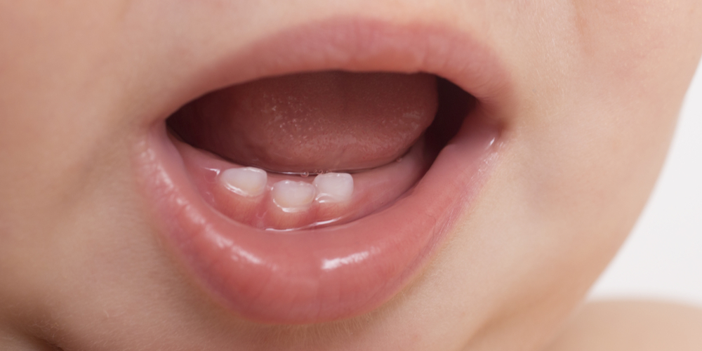 Why Are Milk Teeth Important ? - Vanilla Smiles Dental Clinic
