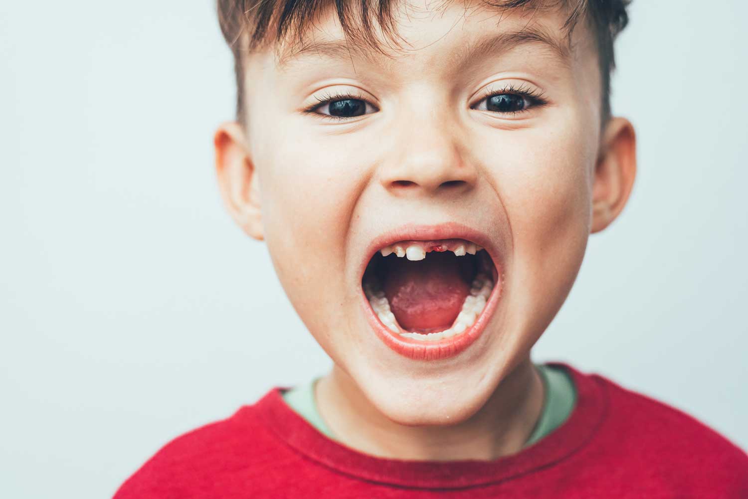 Dental Trauma in Kids | Avulsed Injury Prevention in Pune